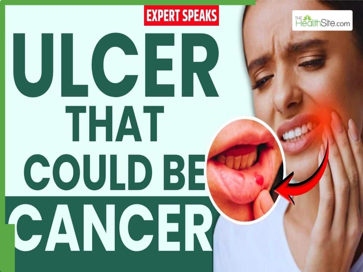 Is it just a mouth ulcer? Expert explains early symptoms of oral cancer ...