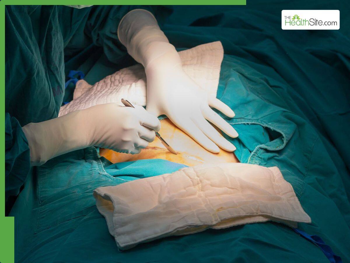 Rising c-section rates worldwide: Hidden risks, causes and why ...