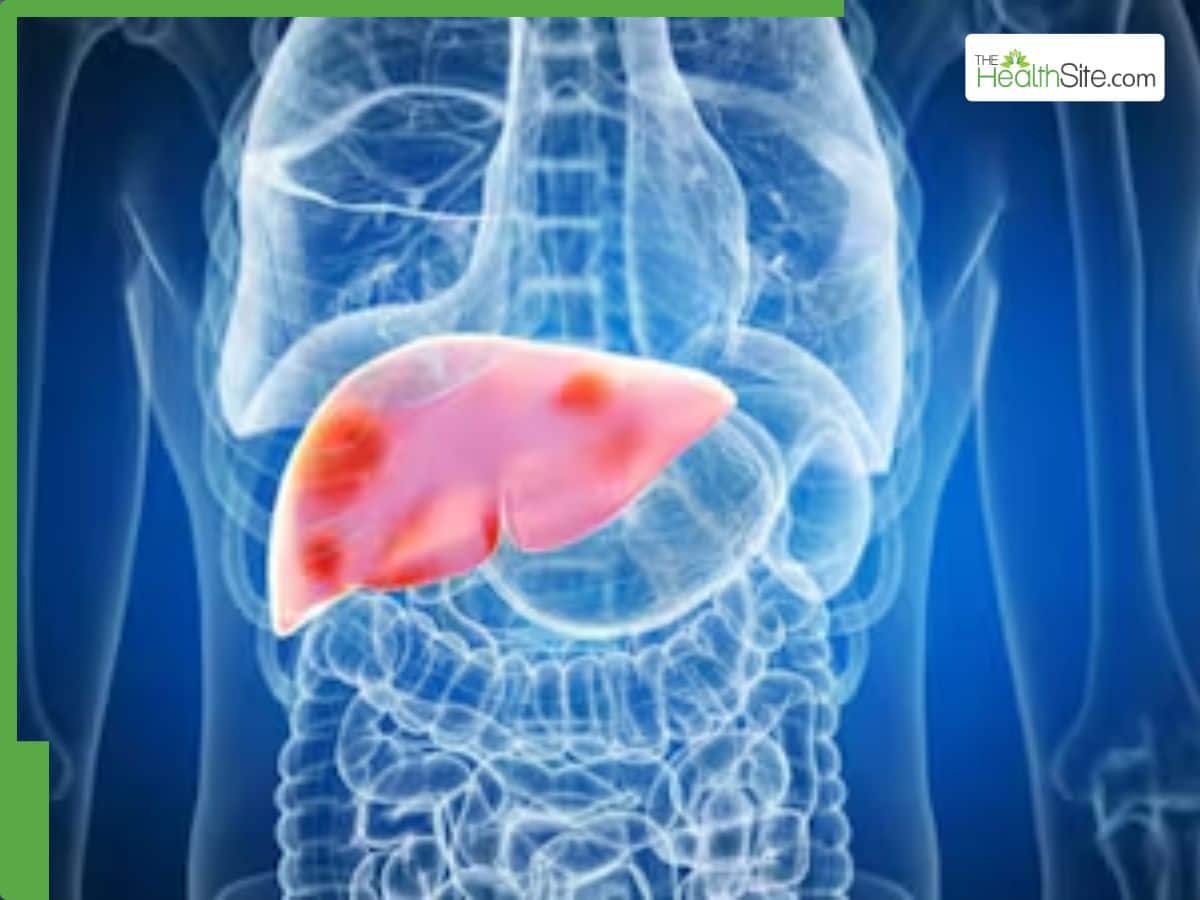 World Liver Day 2026: Alcohol vs lifestyle, what’s really harming your ...