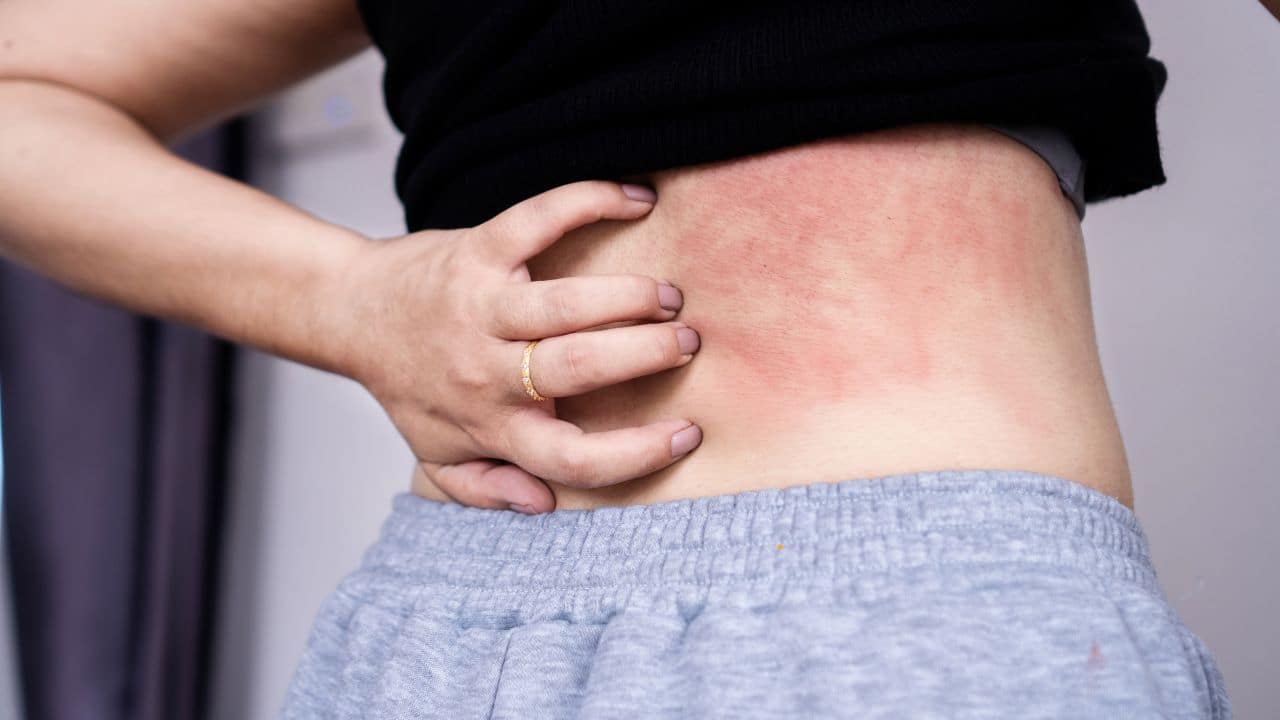 Acne, fungal infections and dermatitis affect millions as 1 in 4 people ...
